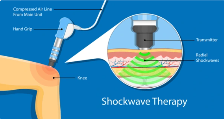 Effects of supplementing extracorporeal shockwave therapy (ESWT) to ...