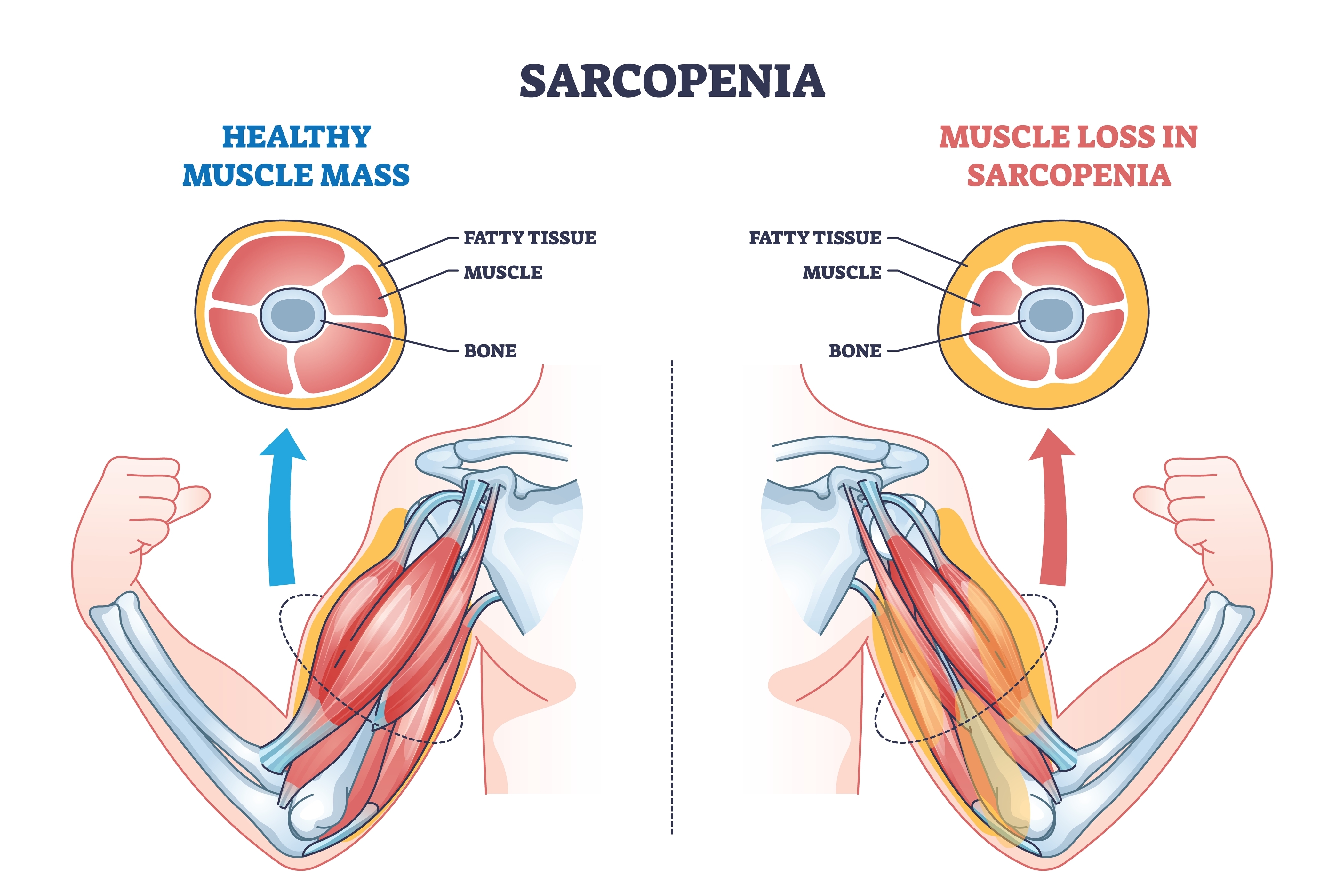 Impact of sarcopenia on outcomes following lumbar spine surgery for ...