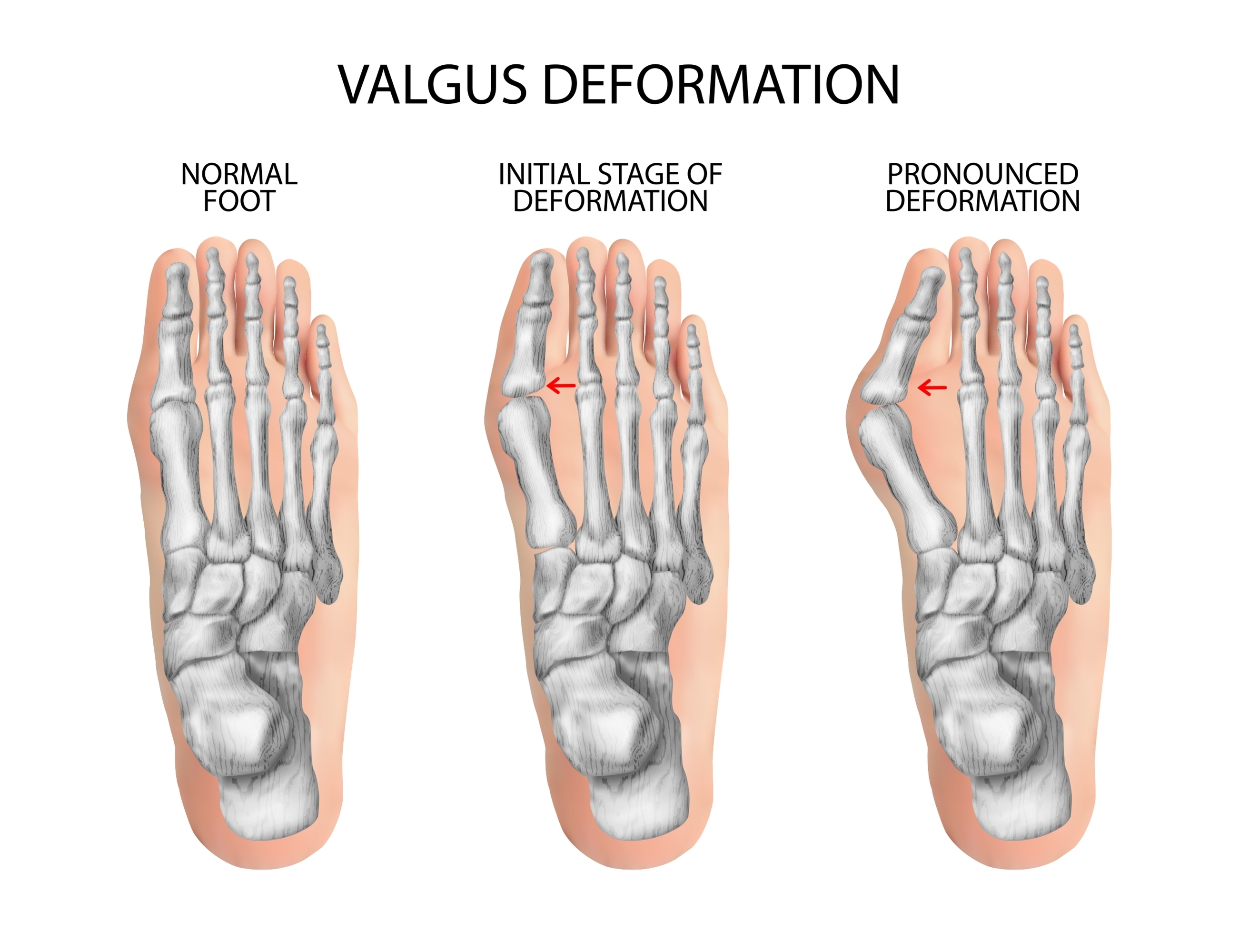Impact of Vitamin D Receptor Genotypes on Taiwan Hallux Valgus | News ...