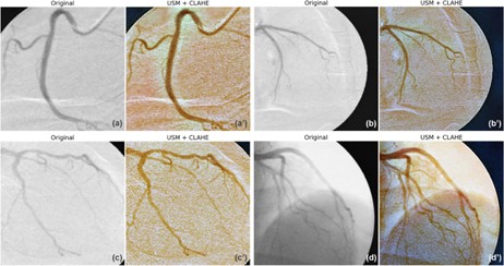 Optimizing ensemble U-Net architectures for robust coronary vessel segmentation in angiographic ...