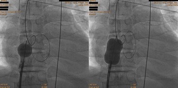 Atrial Septostomy for Left Atrial Decompression During Extracorporeal ...
